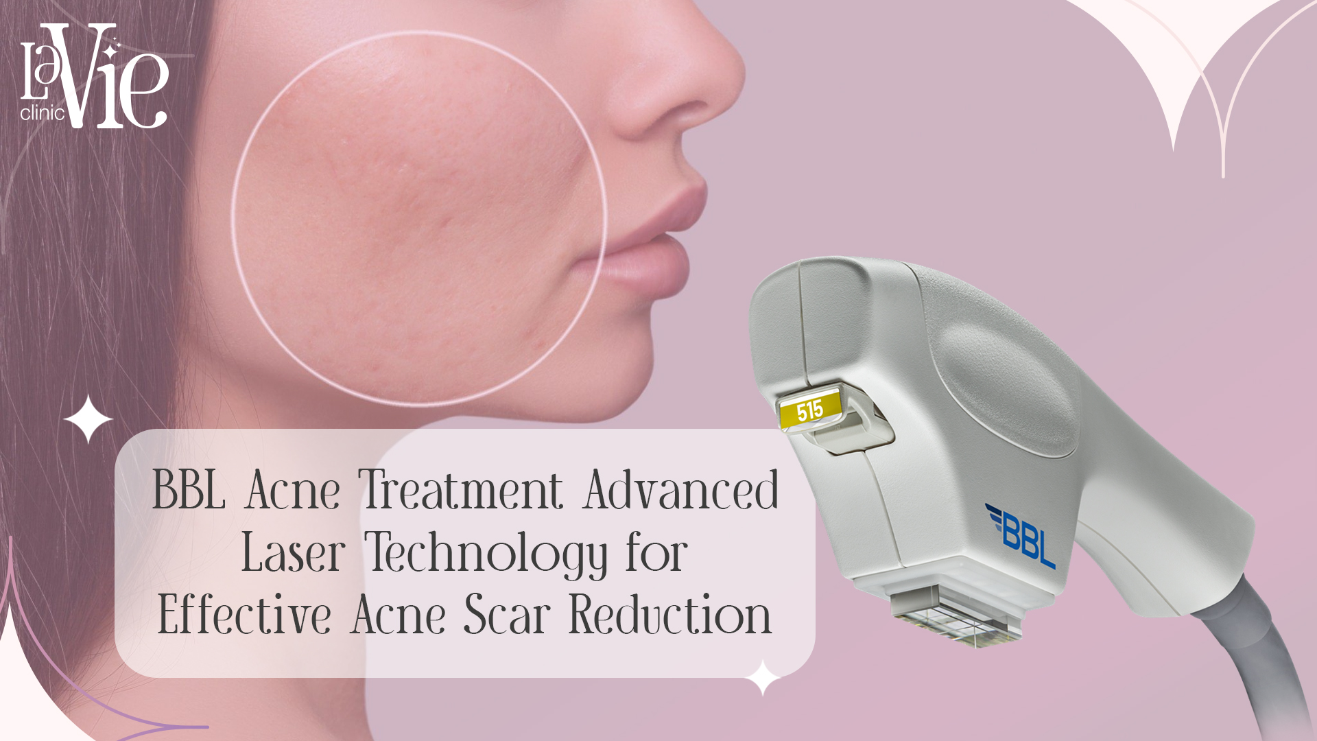 How Long Dose It Take To Recover Form BBL And Moxi Laser How Long Dose It Take To Recover Form BBL And Moxi Laser