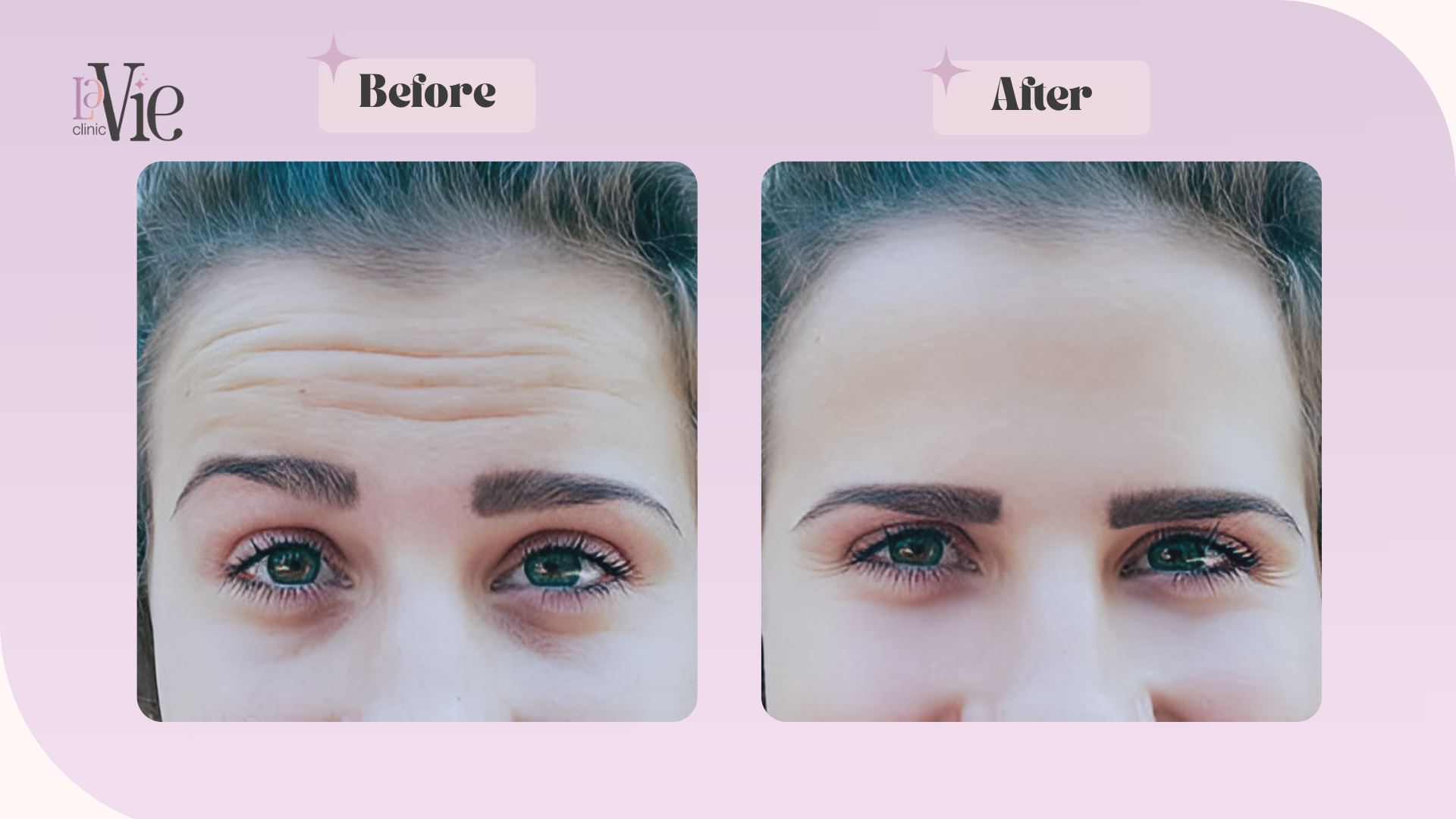 Microtox vs Botox: What You Need to Know