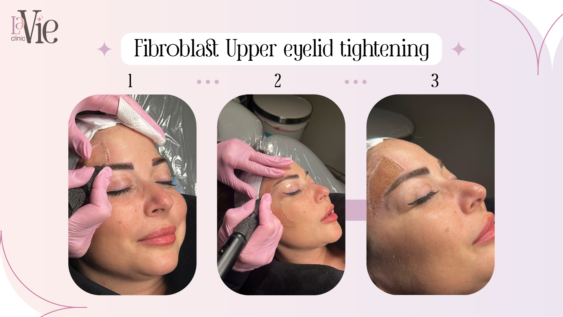 Skin Tightening in Rochester Hills & Clawson, MI