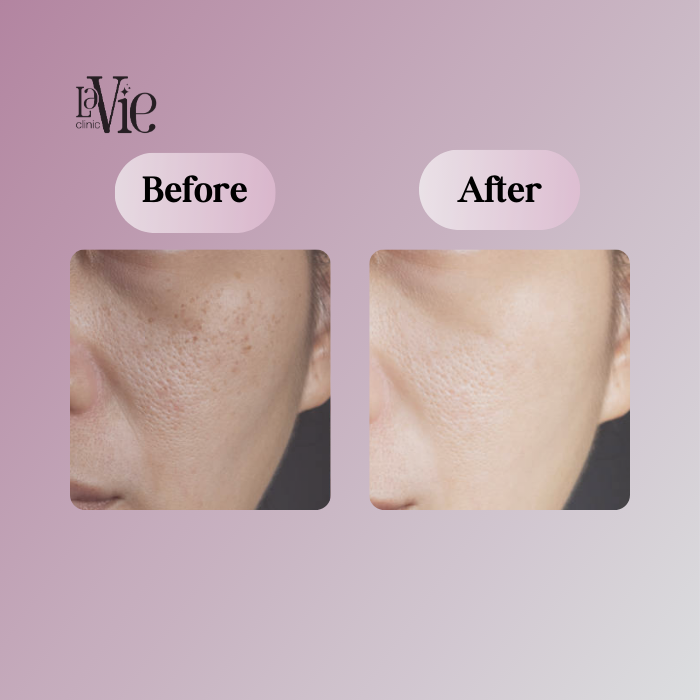 Enlarged Pores Treatment in Rochester Hills & Clawson, MI