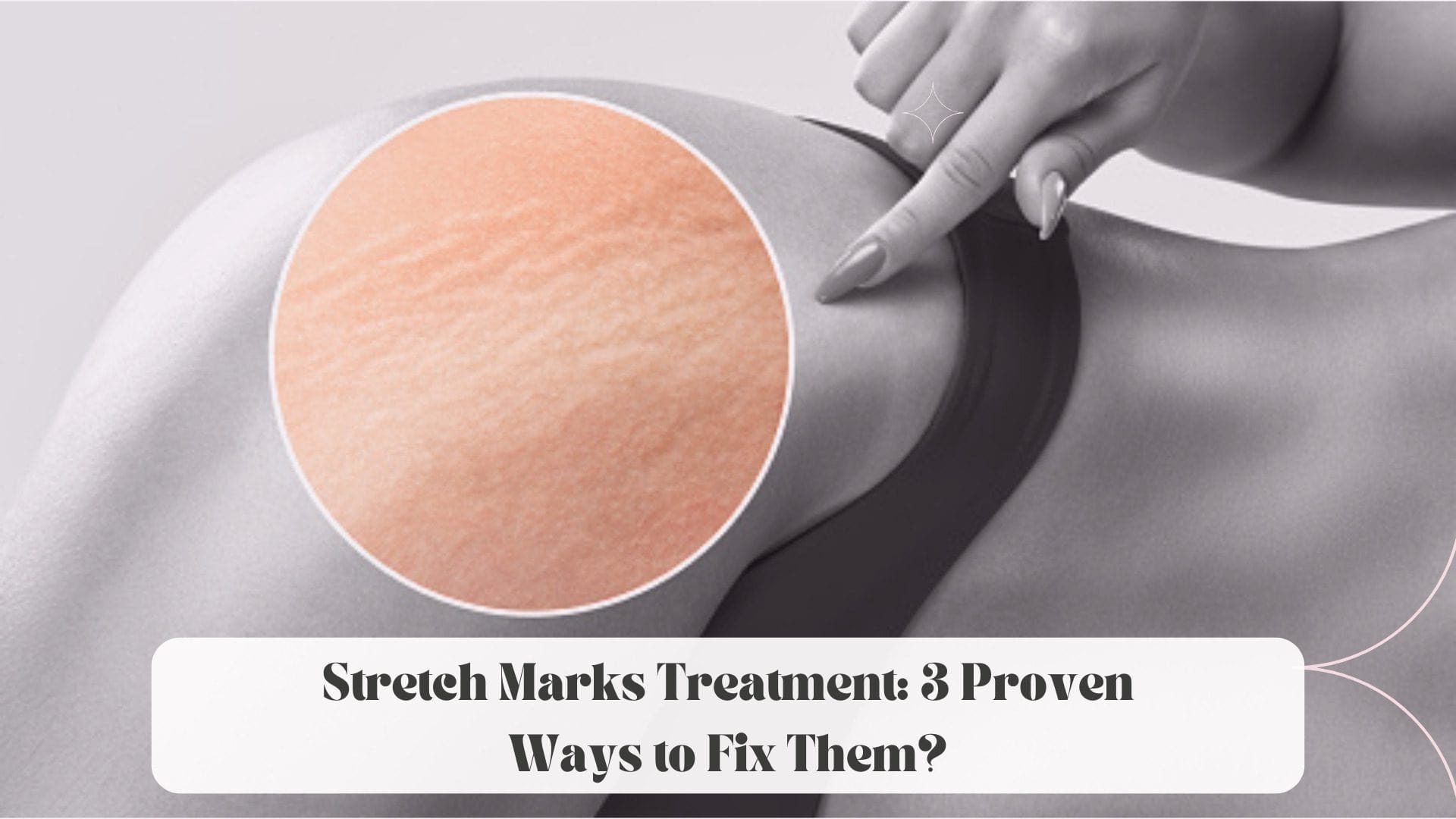 Stretch Marks Treatment: 3 Proven Ways to Fix Them?